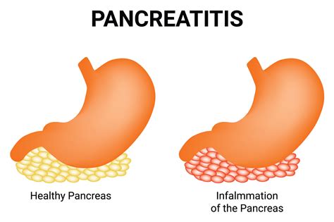 Pancreatitis Science Design Vector Graphic By Hamjaiu · Creative Fabrica