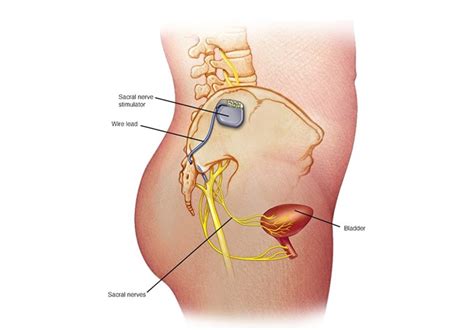 Sacral Neuromodulation In The Male Patient Mayo Clinic