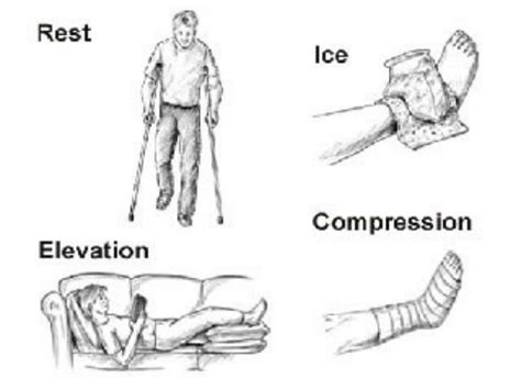 Strain Sprain Fracture