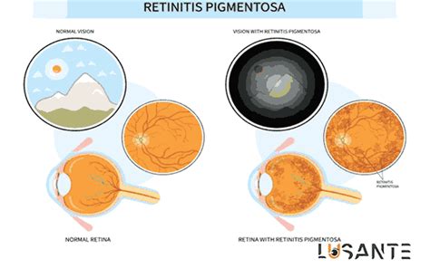 Peripheral Vision Loss And Tunnel Vision Key Symptoms Causes And