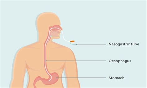 Investigation report: Placement of nasogastric tubes