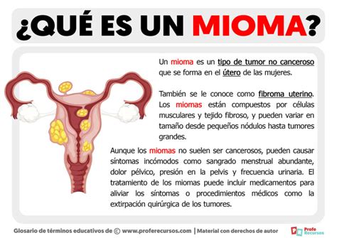 Qué es un Mioma Definición de Mioma