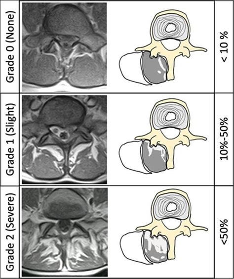 Lumbar Canal Stenosis Recent Advances Etiological Classification