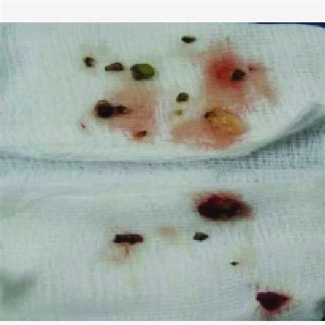 Figure1 Anterior Abdominal Abscess After Drainage Download