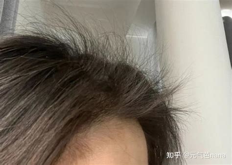 25岁少白头最后成功改善我都做了啥 知乎