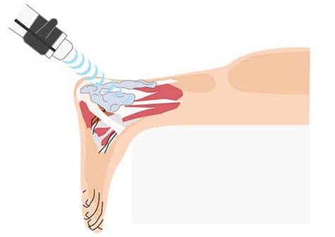 Tratamento por Ondas de Choque alivia dores articulares Clínica Dr Hong Jin Pai Dor