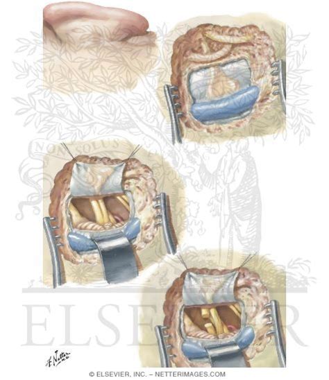 Vestibular Nerve Section