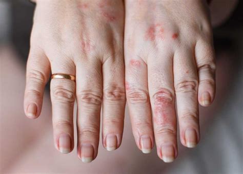 How To Treat Chemical Burns From Laundry Detergent Expert Guide