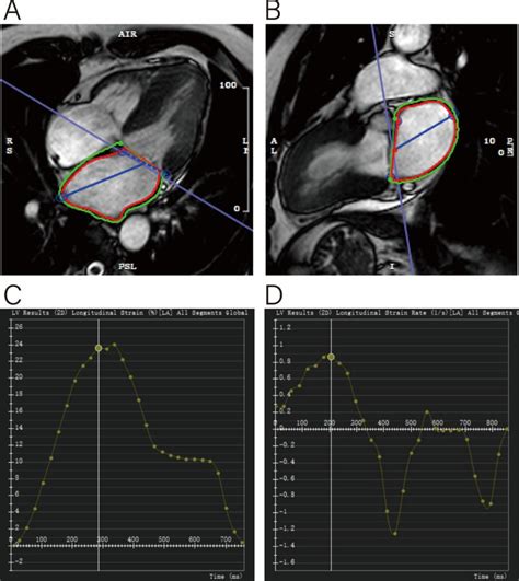 male 56 year la measurements by cmr feature tracking a and b la