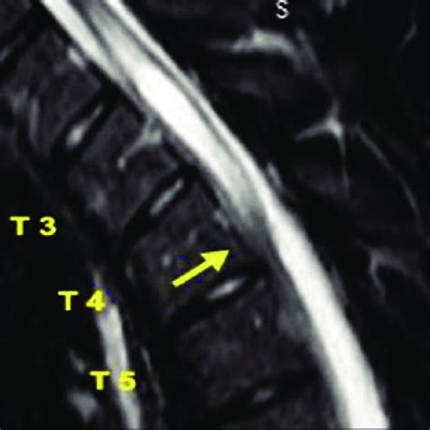 Computed Tomography Myelogram Of The Spinal Cord Obtained 1 Month After