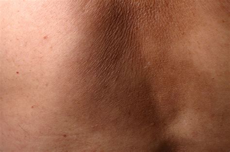 Atrophoderma Of Pasini And Pierini The Clinical Advisor