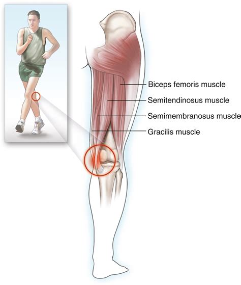 Hamstring Tendon Injection Clinical Tree