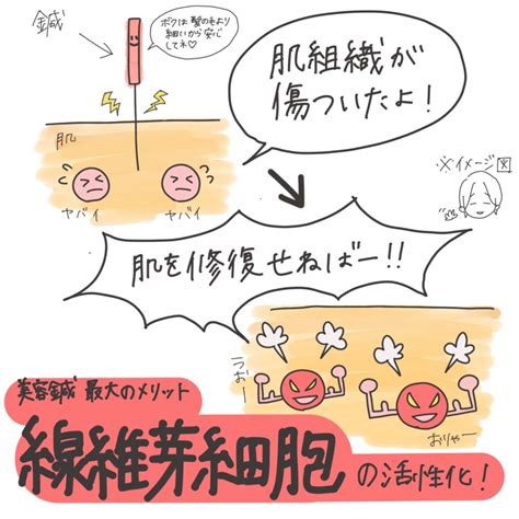 美容鍼はなぜ効くの？ お知らせ｜ながき鍼灸整骨院