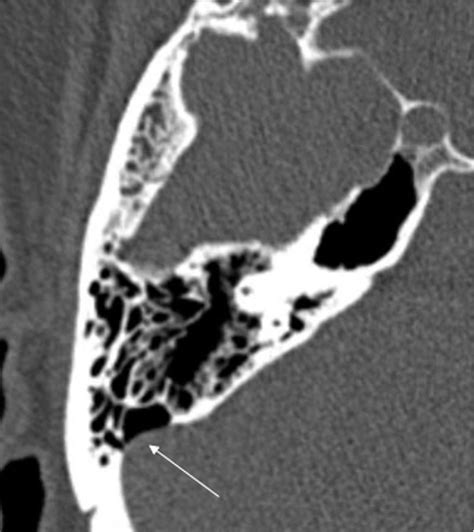 Figure 1 From Prevalence Of Sigmoid Sinus Dehiscence And Diverticulum