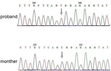 Sanger Sequencing Validation For The Mutation Of Rps6ka3 In The Proband