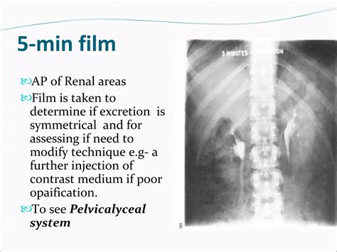 Intravenous Urography IVU By Dr Bishnu Khatiwada Conventional IVU CT IVU MRI PDF