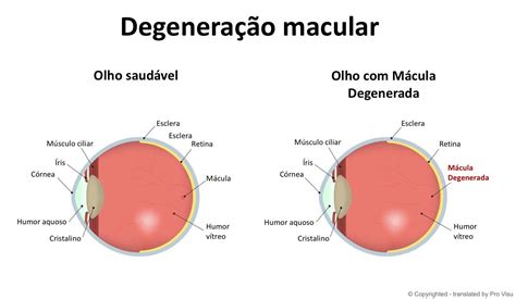 Degeneração Macular relacionada a idade Clínica de Olhos Arruda Mello