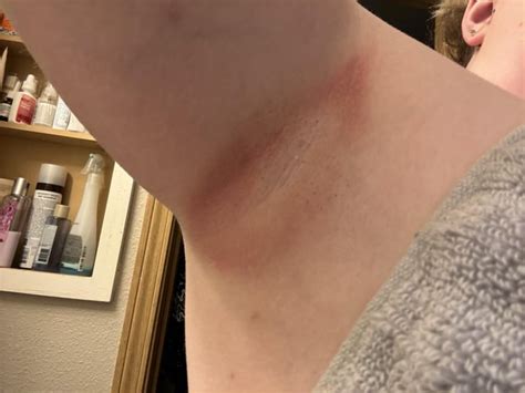 Armpit Rash Rdermatologyquestions