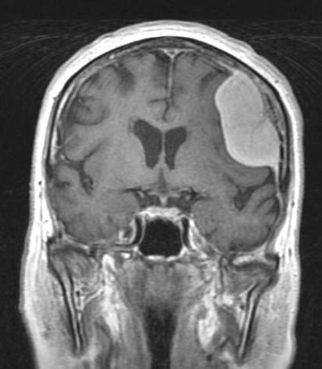 Right Parietal Convexity