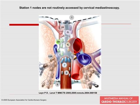 Mediastinoscopy And Mediastinotomy Indications And Techniques