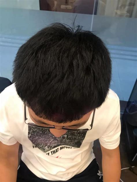 科发源 植发6个月 知乎