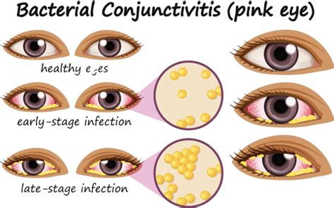 Eye Conjunctivitis Clipart Png Vector Psd And Clipart With