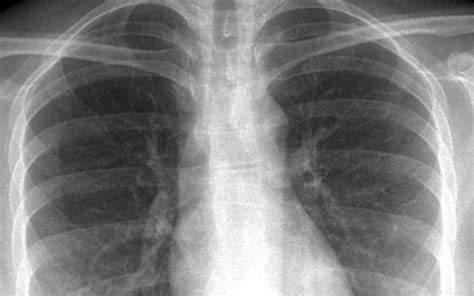Mesotelioma pericardico cos è sintomi diagnosi e cura