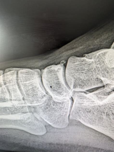 Navicular Fracture R Orthopedics