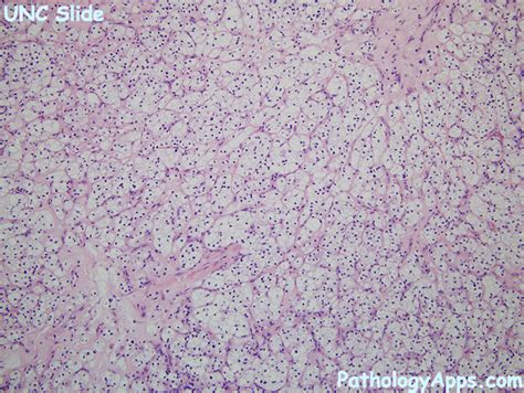 Clear Cell Rcc Pathology