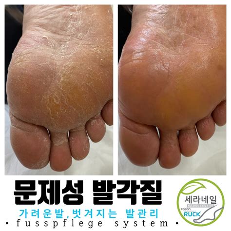문제성 발 관리 세라네일푸스랩