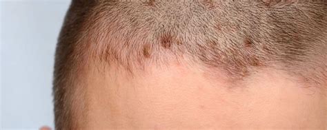 Seborrheic Alopecia How It Develops And What Are The Remedies
