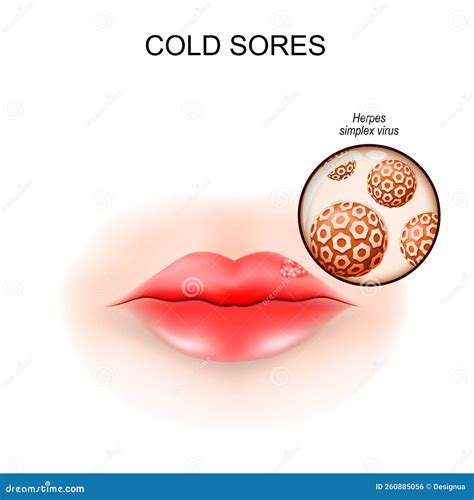 Cold Sores In The Lip Fever Blisters Stock Vector Illustration Of