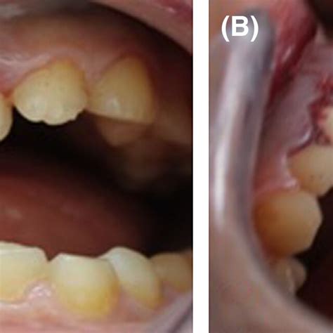 Bleeding At The Gingival Sulcus Download Scientific Diagram