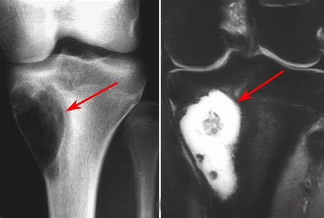 Osteosarcoma Orthoinfo Aaos
