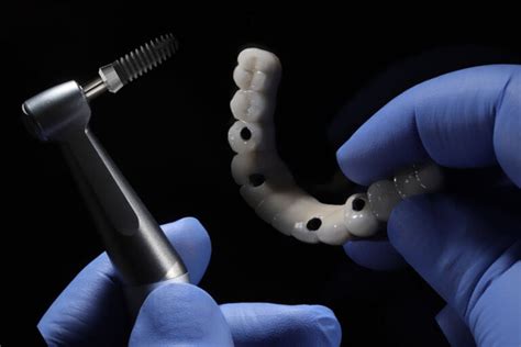 Transforming Smiles With Full Mouth Dental Implants In Floris Va