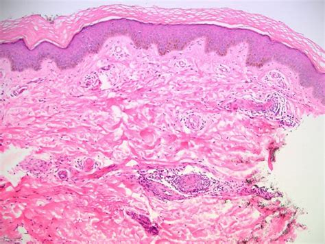 Figure 2 From Does Lymphocytic Thrombophilic Arteritis Have A Wider