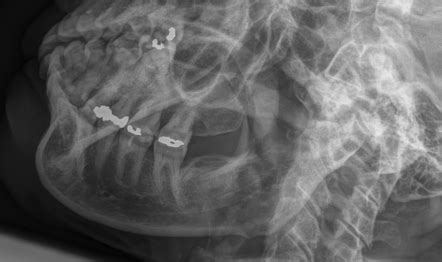 Mandible Axiolateral Oblique View Radiology Reference Article