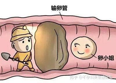 输卵管堵塞疏通术后多久可以怀孕 知乎