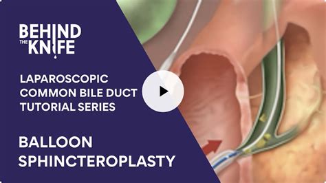 4 Laparoscopic Common Bile Duct Tutorial Series Balloon