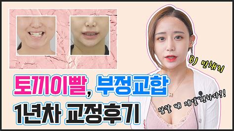부정교합 토끼이빨 잠잘 때 숨쉬기도 힘들었던 교정전후 찐후기는 치아교정 1년 후 후기 네이버 Tv