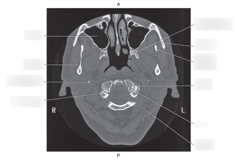 Axial Ct Of Occipital Bone At Level Of Foramen Magnum Diagram Quizlet