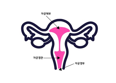 젊은 여성층에서 감기만큼 흔한 자궁근종