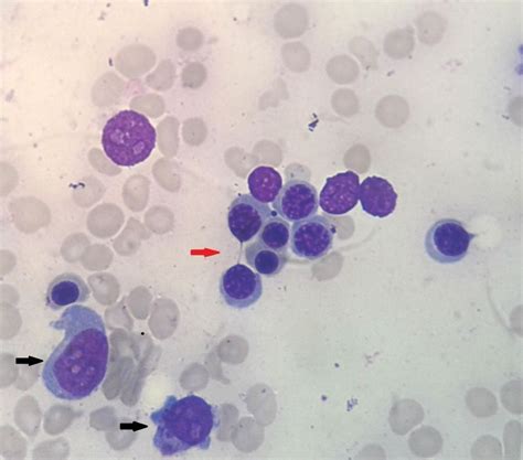 Diseritropoyesis Y Exceso De Blastos En Un Paciente Con AREB
