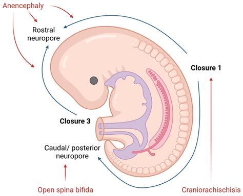 Neural Tube Defects Ntds What They Are Causes 53 Off