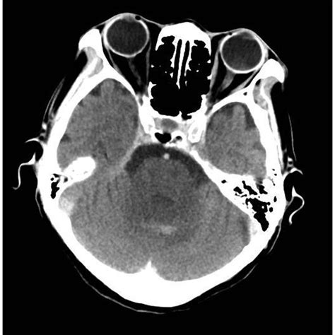 Postoperative Head Computed Tomography Demonstrating A High Density