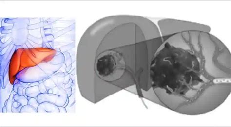 Minimal Invasive Tace Procedure For Recurrent Liver Cancer Improves