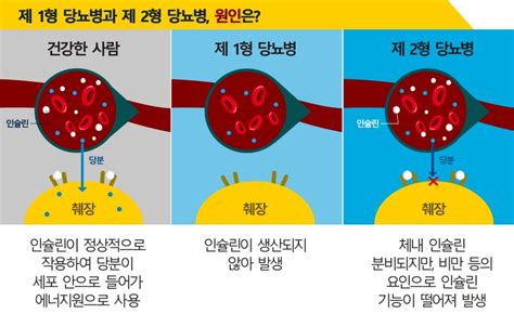 1형당뇨 2형당뇨 차이