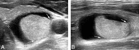Figure 2 From Sonographic Differentiation Of Partially Cystic Thyroid