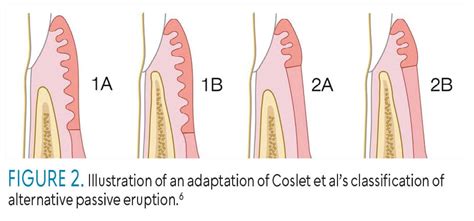 Understanding Altered Passive Eruption Dimensions Of Dental Hygiene