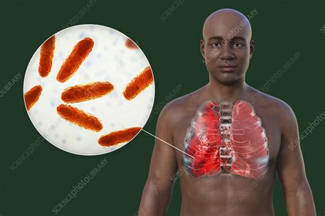 Man With Lungs Affected By Pneumonia Illustration Stock Image F041
